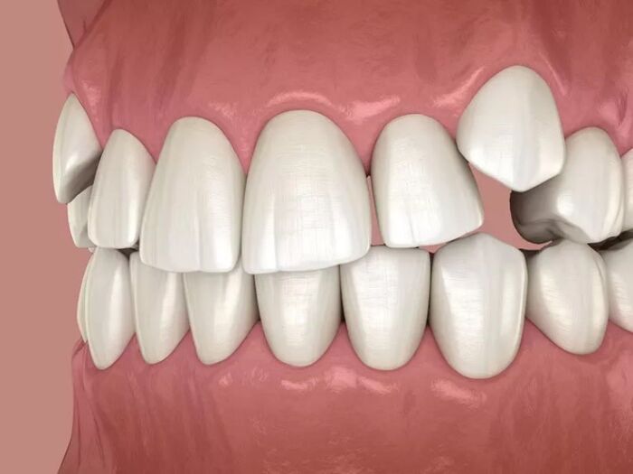 ZagrebMed - Correction of protruding teeth in Zagreb - zagrebmed.com